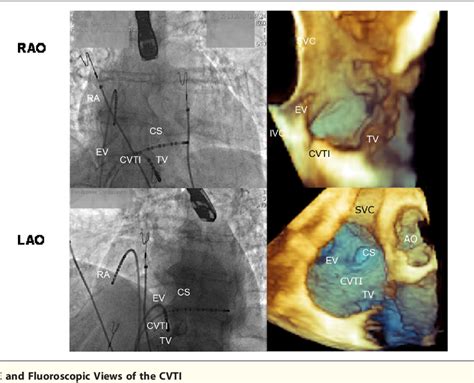 Figure 1 From Feasibility And Acute Efficacy Of Radiofrequency Ablation Of Cavotricuspid Isthmus