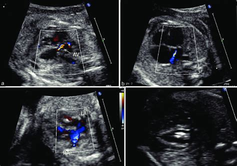 Fetal Echocardiographic Images Prior To Procedure A Color Doppler