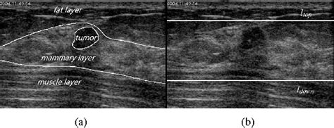 Figure 1 From A Saliency Model For Automated Tumor Detection In Breast Ultrasound Images