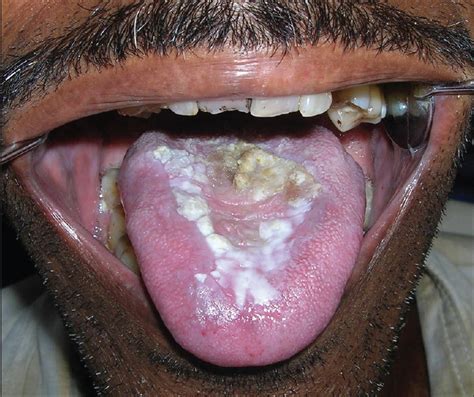 Surgical Management Of Chronic Hyperplastic Candidiasis Refractory To