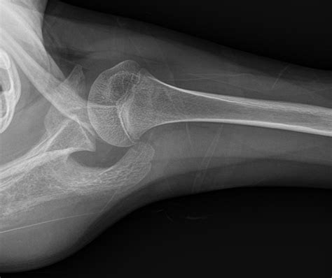 Ewings Sarcoma X Ray