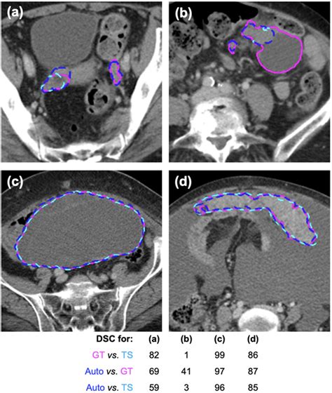 12 Segmentation Examples For The Cases With Median And Maximum Dsc A Download Scientific