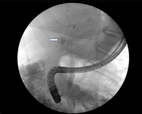 ERCP Image Days After The Biopsy Shows Contrast Extravasation From A Download Scientific
