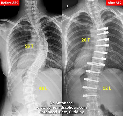 Anterior Scoliosis Correction Asc Non Fusion Scoliosis Surgery