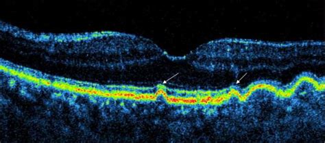 Sd Oct Showing Drusens Drusen Appears As Irregular Elevations Of The Download Scientific
