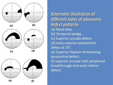 VF In Glaucoma Pptx
