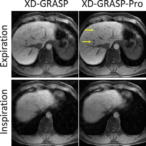 Figure 3 Comparison Of Xd Grasp Andxd Grasp Pro Reconstruction In The
