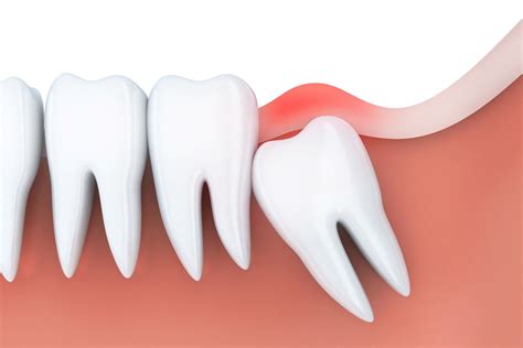 Top 3 Causes Of Wisdom Tooth Removal