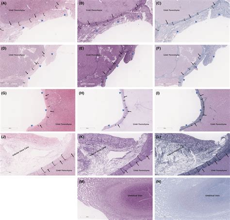 Histological Findings Of Laennecs Capsule In The Liver Tissues Of The Download Scientific