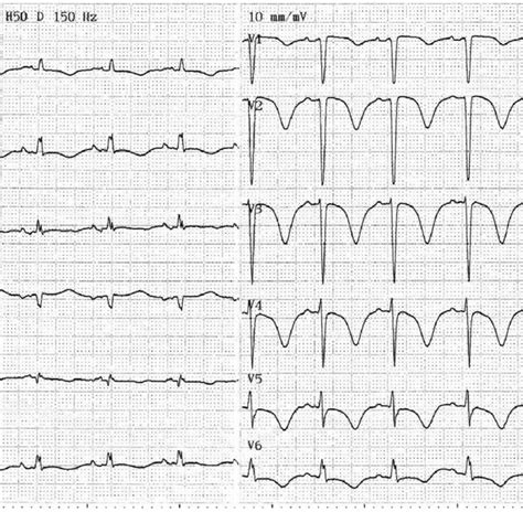 Ecg With Severely Prolonged Qt Interval And Initiation Of Fast Download Scientific Diagram