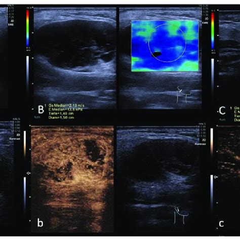 Malignant Parotid Gland Lesion Squamous Cell Carcinoma Metastasis