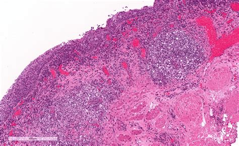 Pathology Outlines Follicular Cystitis
