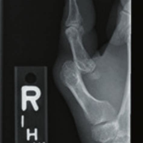 Post Operative Photograph Of Right Hand Showing The MP And IP Joints Download Scientific