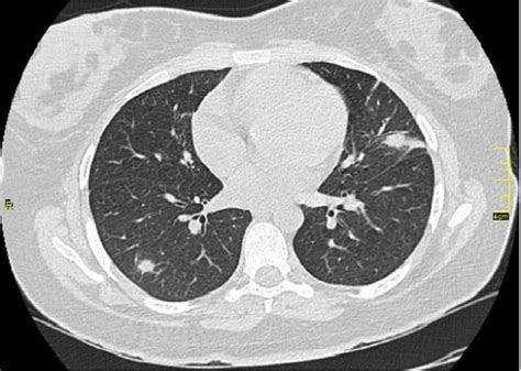 Computed Tomography Of Chest Showing Lung Nodules Download Scientific Diagram