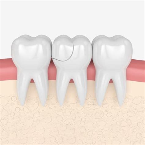 Chipped Tooth Repair Molar