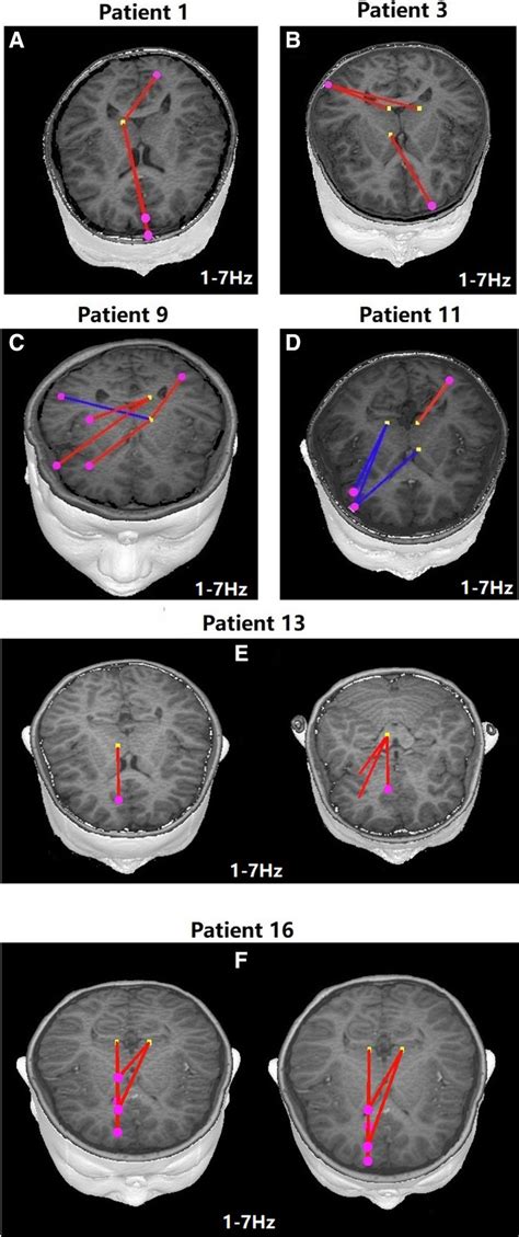 The Fronto Cortico Occipital Functional Connectivity Fc A Download Scientific Diagram