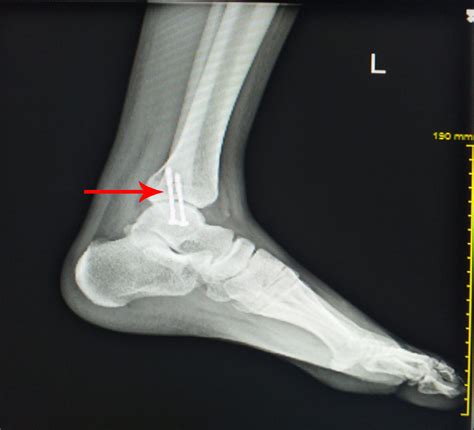 Arthrodesis Kinvara Private Hospital 01709 464200