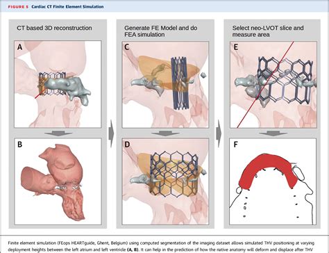 Figure 5 From Management Of Patients With Severe Mitral Annular