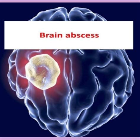 Brain Abscess Ct Brainabscess Ct Mri Medical Radiographers… Anuj Dubey ⚕️