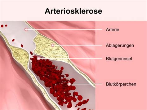 Arteriosklerose Risiken And Symptome Schwabe Austria