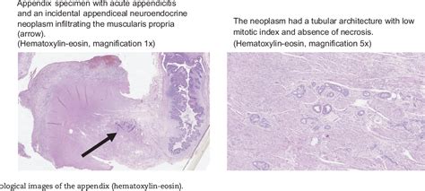 Figure 3 From Neuroendocrine Tumor Of The Appendix—a Case Report And Review Of The Literature