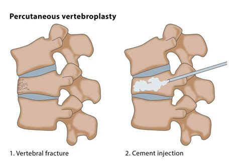 Compression Fracture Lumbar