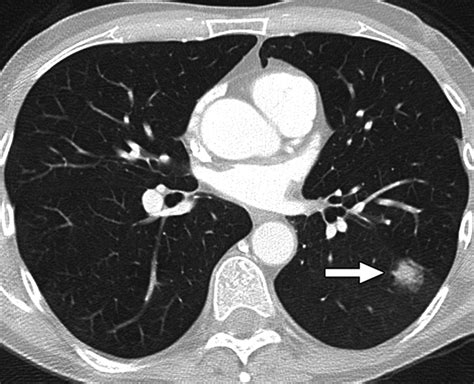 Pulmonary Nodules Detected At Cardiac Ct Comparison Of Images In