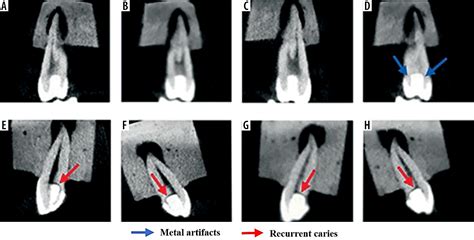 Performance Of Different Cone Beam Computed Tomography Scan Modes With And Without Metal