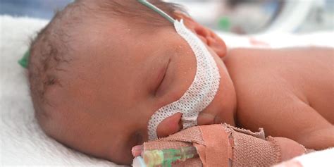 Ai Identifies Bronchopulmonary Dysplasia In Premature Infants