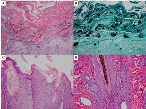 Histopathology Of Common Histologic Features Of Dermatophytosis