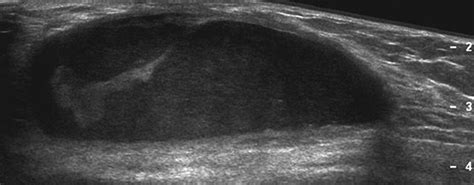 The Postconservation Breast Part 1 Expected Imaging Findings Ajr