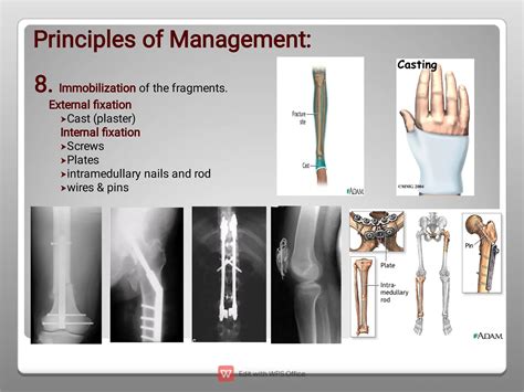 Definition Of Fracture Its Types Symptoms And Treatment Ppt