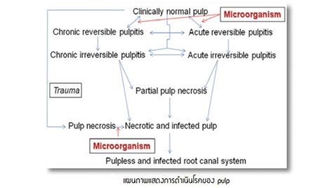 สมาคมเอ็นโดดอนติกส์แห่งประเทศไทย การดำเนินของโรค Pulp และ Periapical