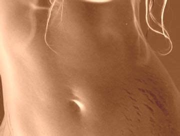 Tools To Help Those Annoying Stretch Marks Fade Away