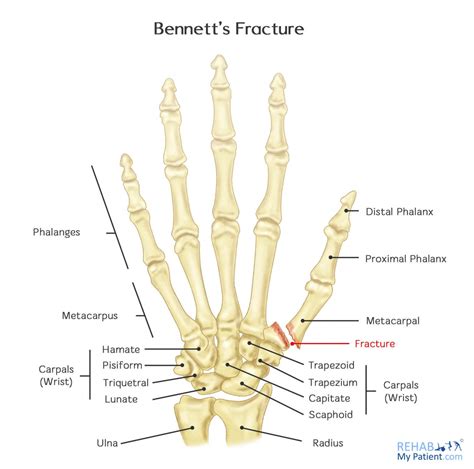 Bennetts Fracture Rehab My Patient