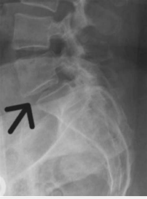 Anterolisthesis In Between Fifth Lumbar Vertebrae And The First Sacral