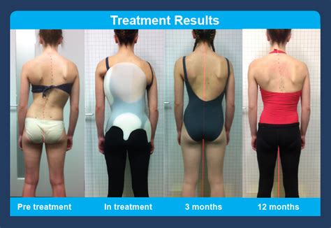 Advanced Scoliosis Brace Hudson Valley Scoliosis