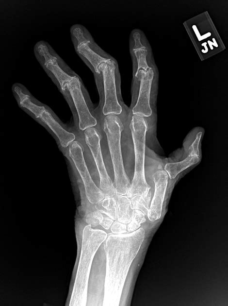 Reactive Arthritis X Ray