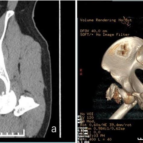 Classification Of Femoral Head And Femoral Neck Fracture （ A