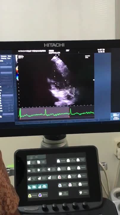 Vfm Vector Flow Mapping Is The Solution Application For Cardiologist