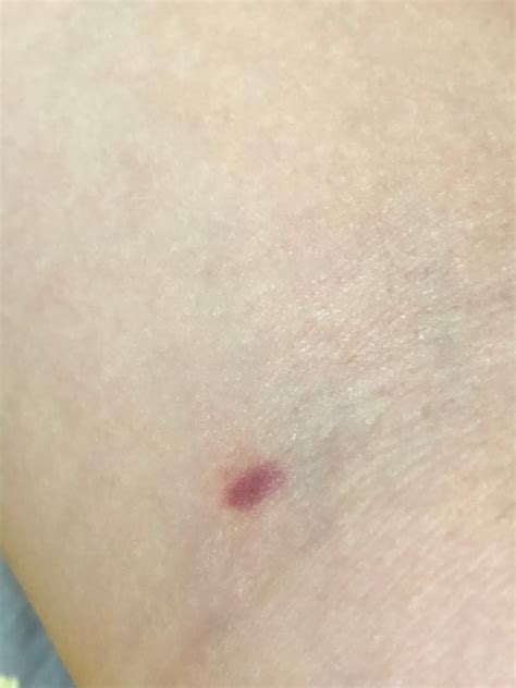 피부 갑자기 생긴 점 지식in