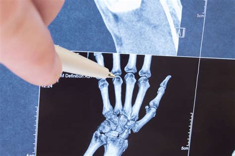 Rheumatoid Arthritis Resources Staying Alive