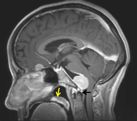 Case Archives — Clival And Foramen Magnum Meningioma Embolization And Transnasal Resection