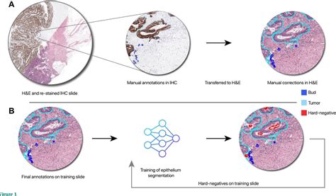Figure 1 From Fully Automated Tumor Bud Assessment In Hematoxylin And Eosin Stained Whole Slide
