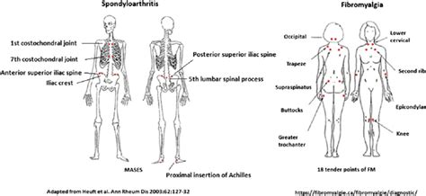 Points Evaluated As 1990 Acr Criteria Tender Points And Mases Lefthand