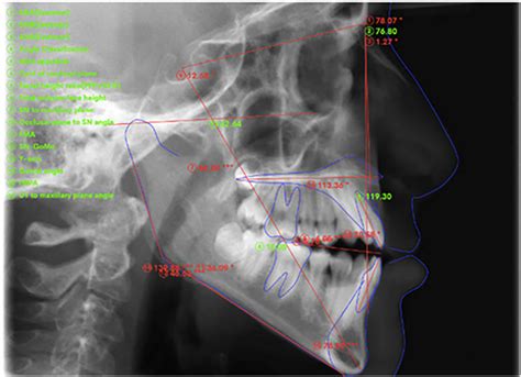 Accuracy Of Gonial Angle Measurements Using Panoramic Imaging Versus