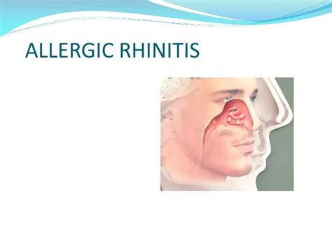 Ppt Allergic Rhinitis Powerpoint Presentation Free Download Id
