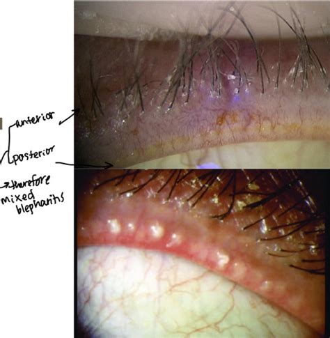 Squamous Blepharitis