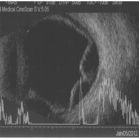 An Ultrasound Image Showing Chorioretinal Detachment And An Impressive