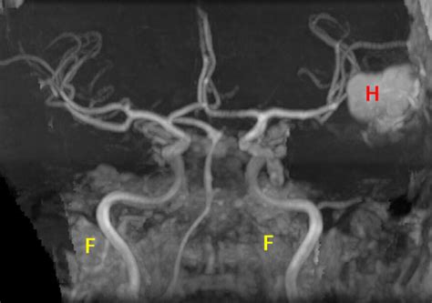 Mra Artifacts Tof Questions And Answers In Mri